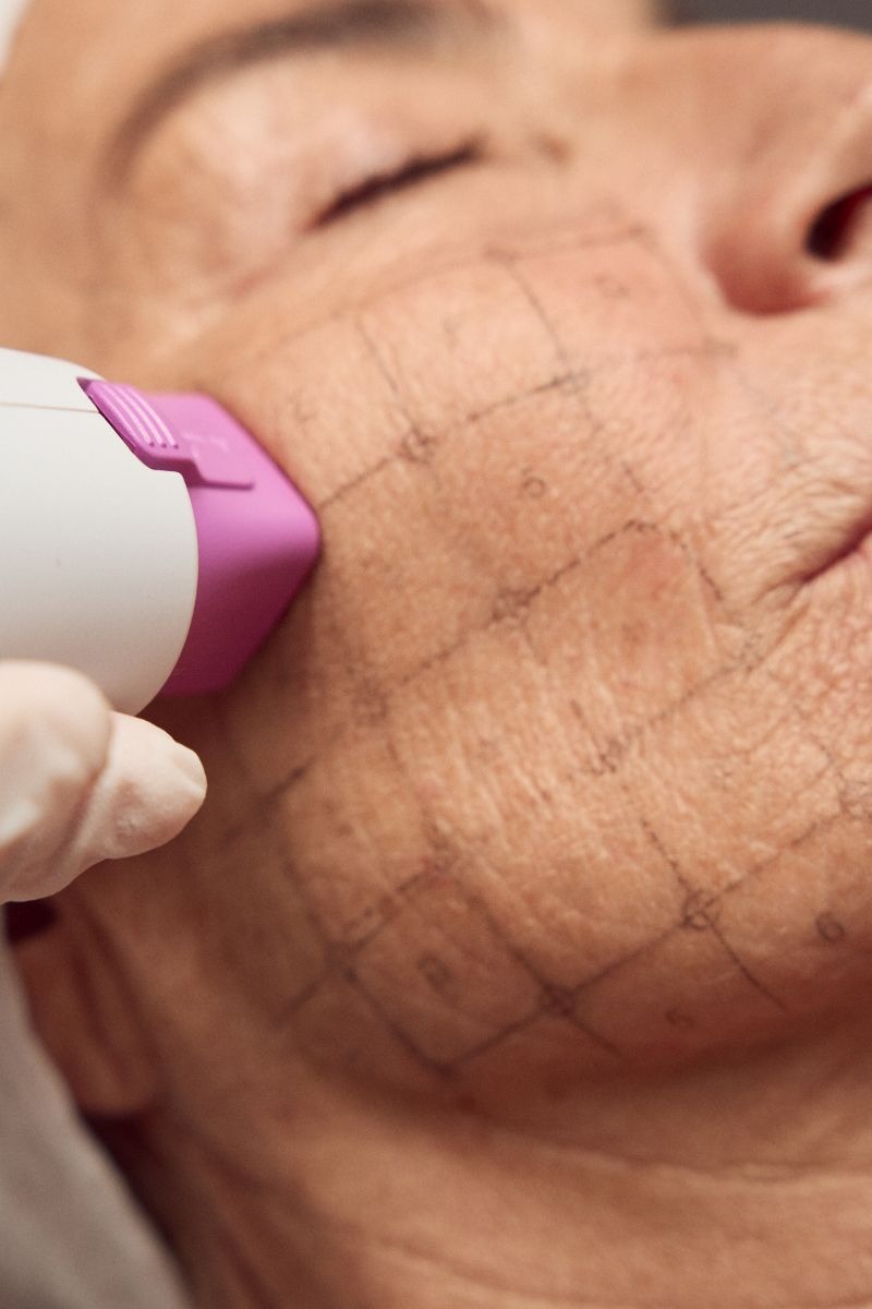 Thermage FLX Body - Demya